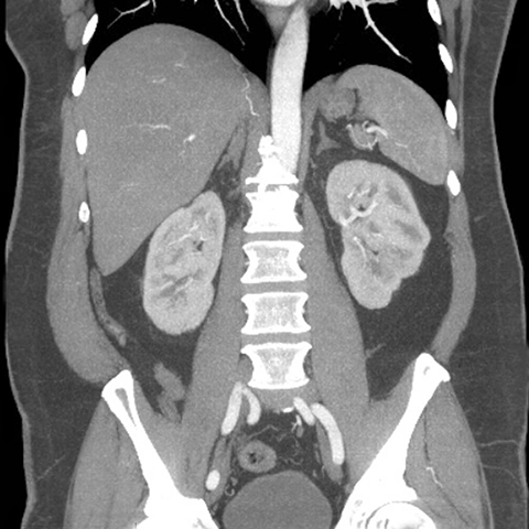 Abdominal Wall Muscles Normal Anatomy, Coronal CT [9 of 9]